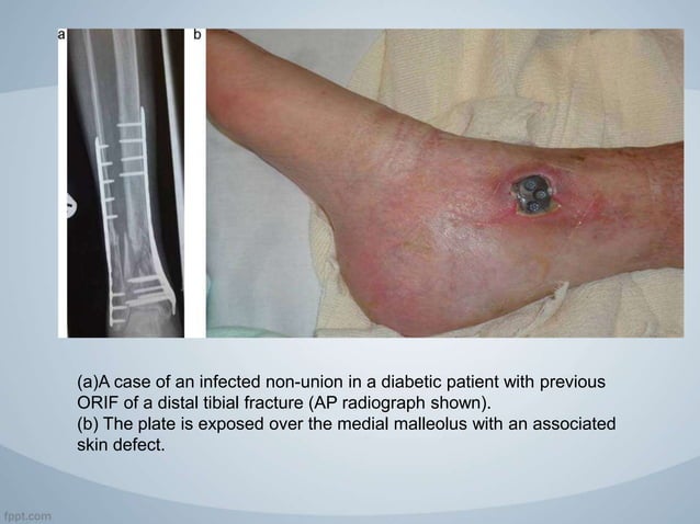 Masquelet technique for management of large bone defects. | PPTX ...