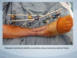 Masquelet technique for management of large bone defects. | PPTX