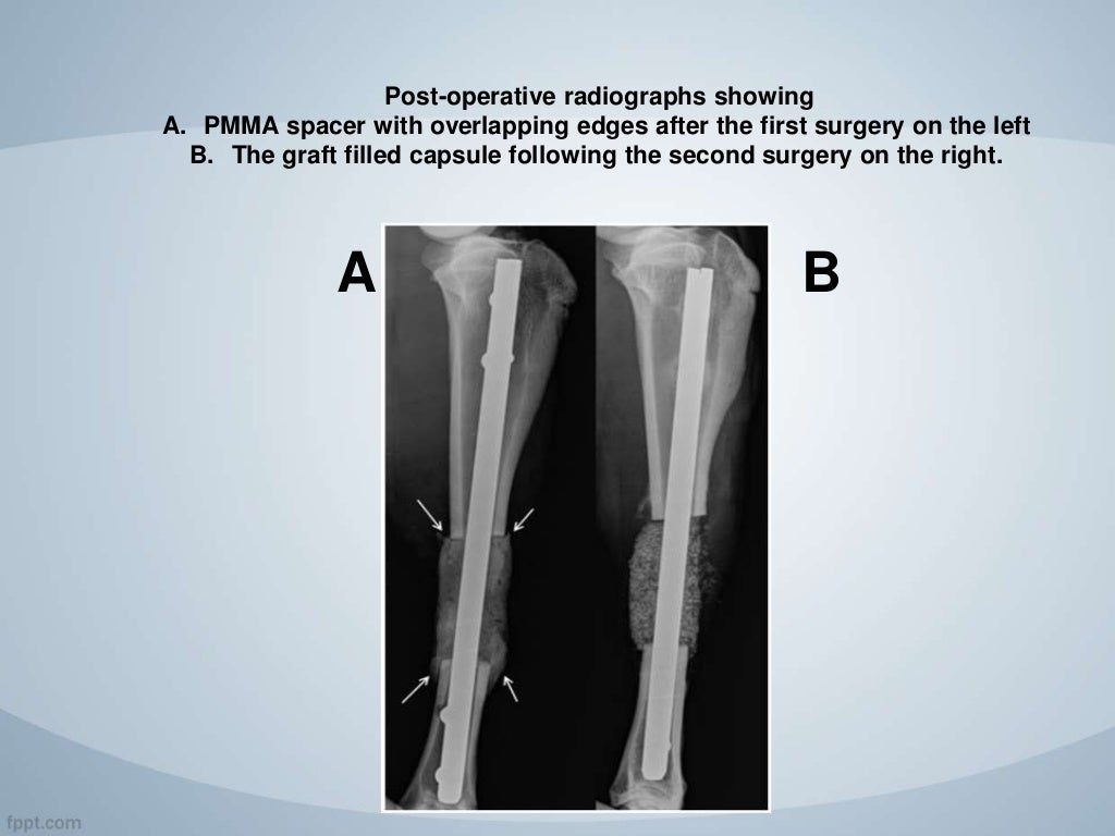 Masquelet technique for management of large bone defects.