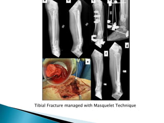 Masquelet Technique | PPT