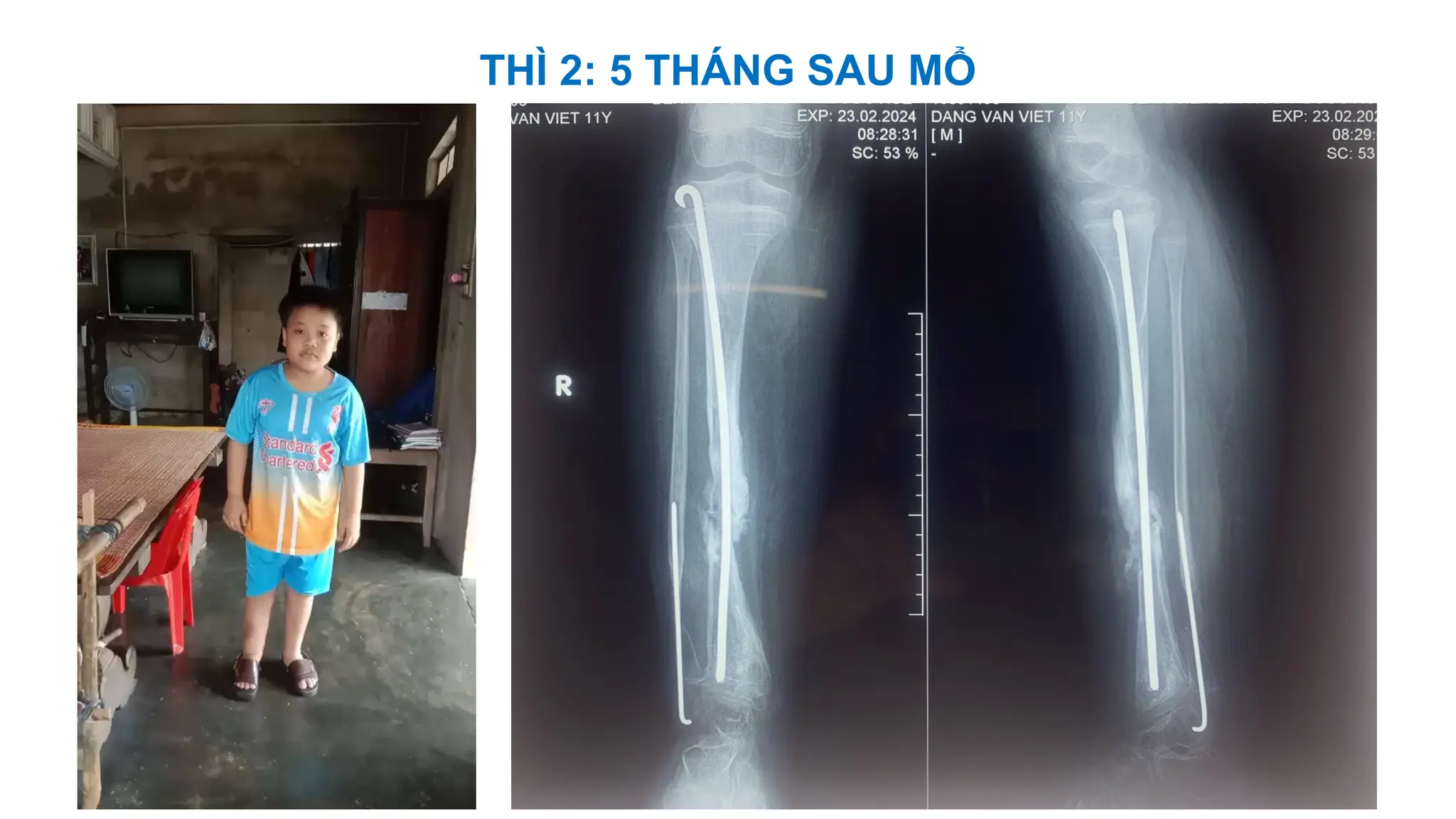 "Two-stage bone grafting using the Masquelet technique: Scientific basis and clinical ...