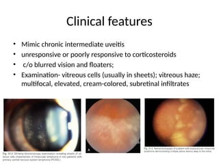 MASQUERADE syndromes in eye ophthalmology | PPTX