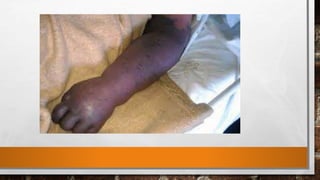 Massage for oedema | PPTX