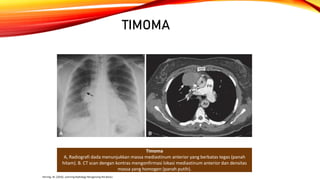Massa Mediastinum.pptx