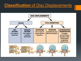 Massive disc herniation – Discectomy Vs Fusion.pptx