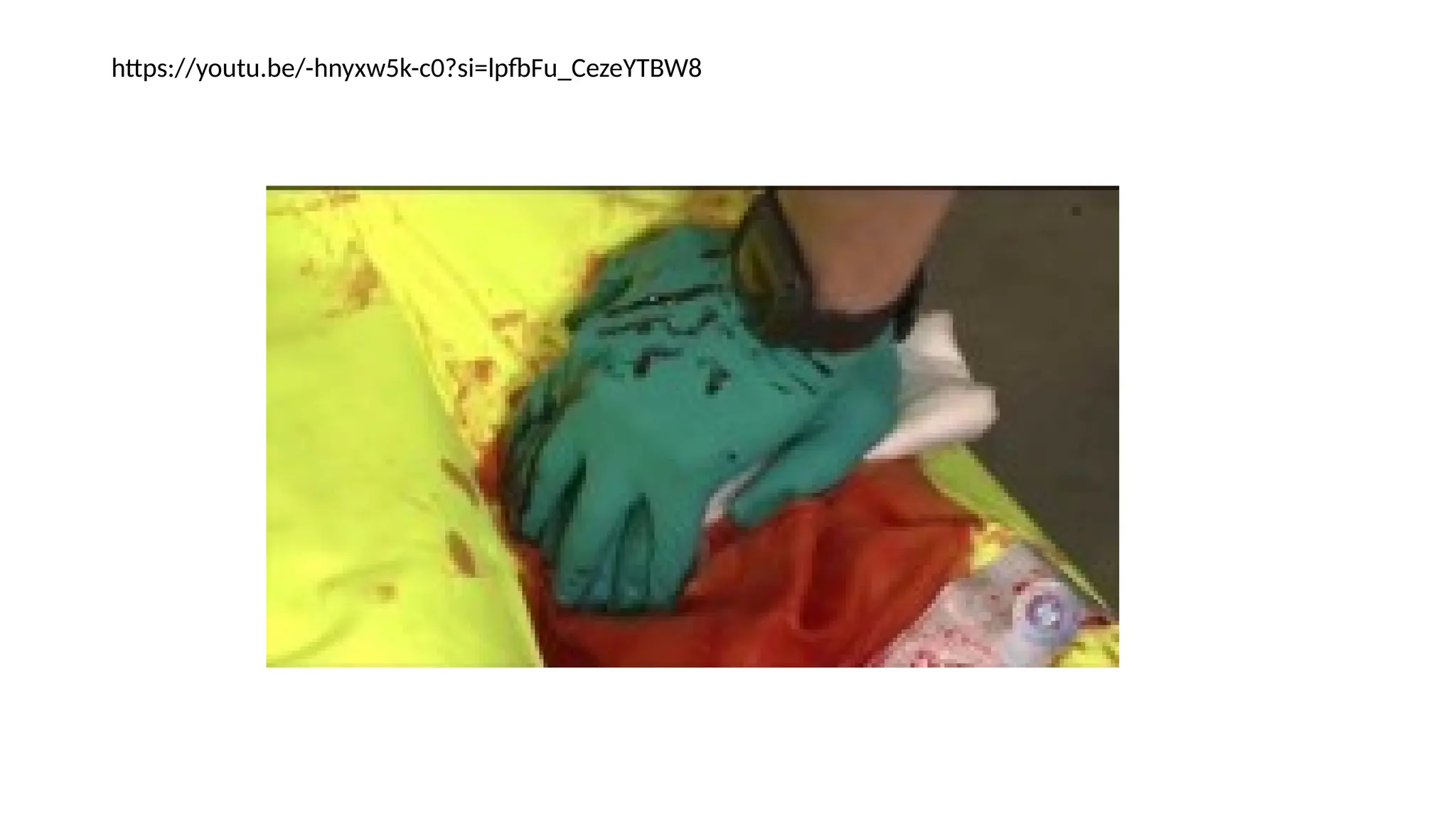 MASSIVE EXTERNAL HEMORRHAGE & Bleeding COntrolpptx | PPTX