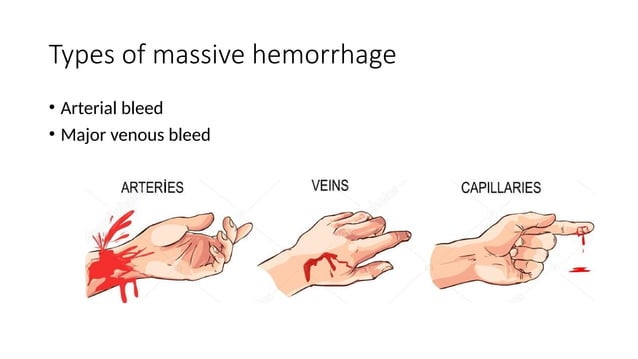 MASSIVE EXTERNAL HEMORRHAGE & Bleeding COntrolpptx | PPTX