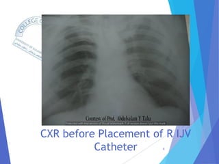 Massive Haemothorax after Right Internal Jugular Venous Catheter ...