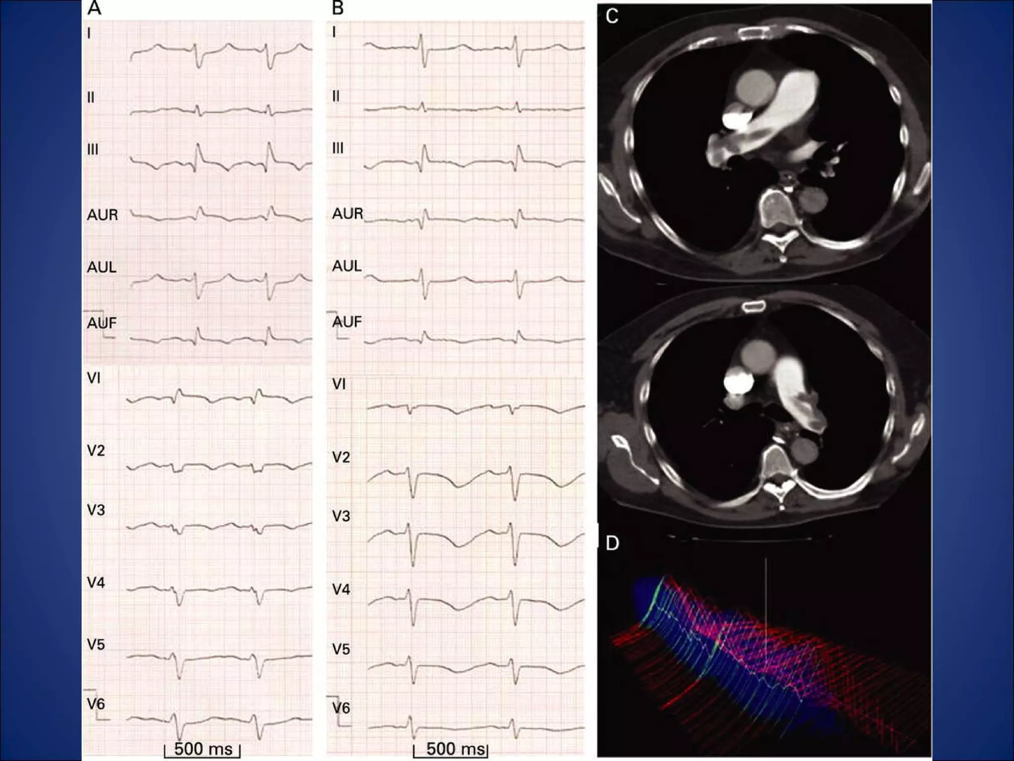 Massive pulmonary embolism case presentation | PPT