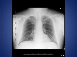 Massive pulmonary embolism case presentation | PPT