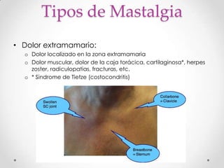 Mastalgia | PPTX
