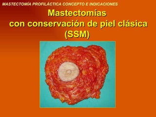 Mastectomia profilactica | PPT