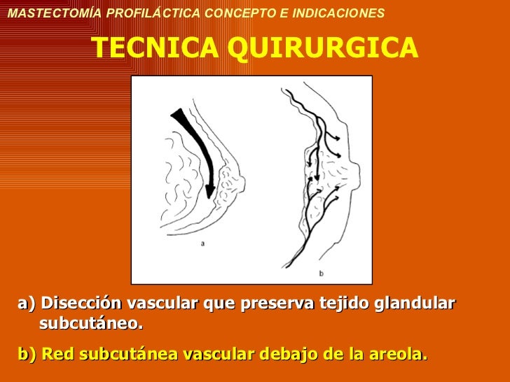 Mastectomia profilactica