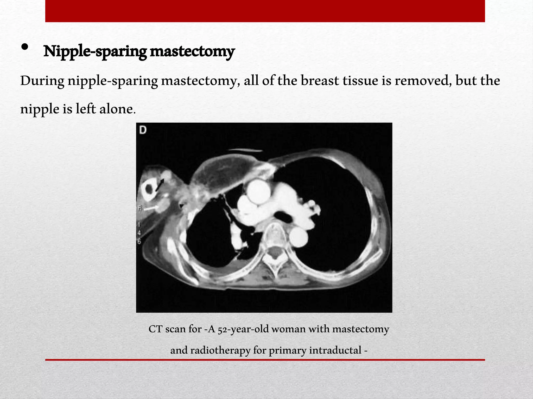Mastectomy | PPTX