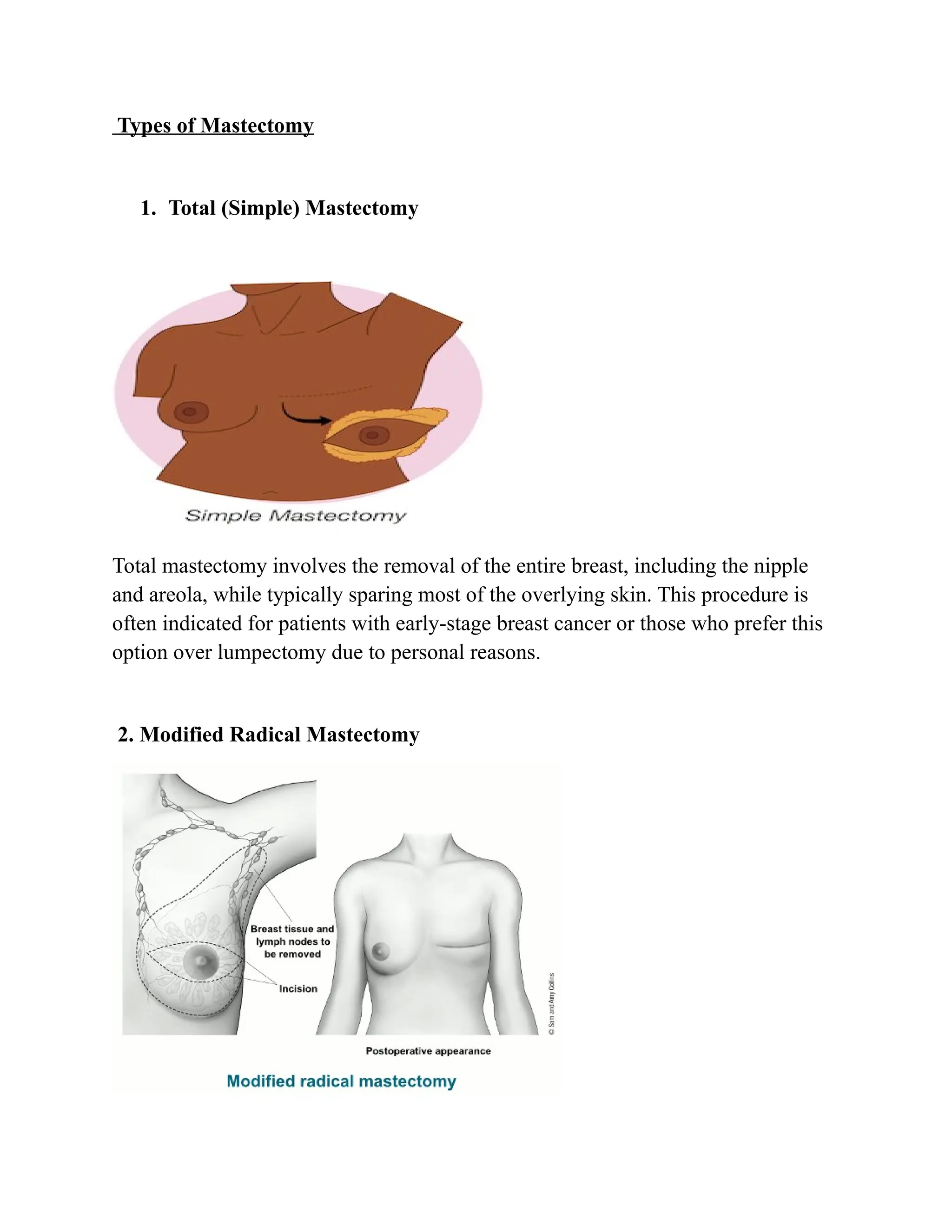 mastectomy and oncosurgery- definition, types ..... | DOCX