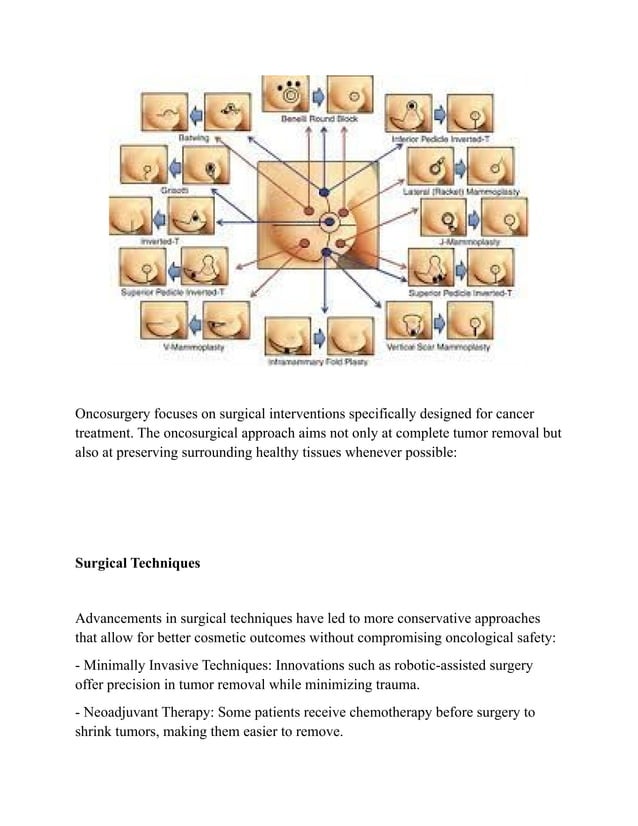 mastectomy and oncosurgery- definition, types ..... | DOCX