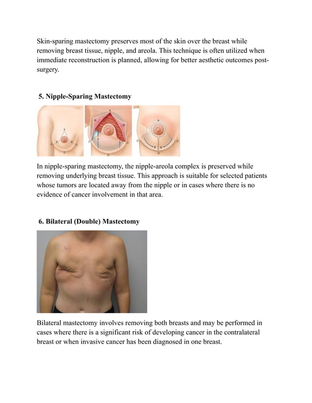 mastectomy and oncosurgery- definition, types ..... | DOCX