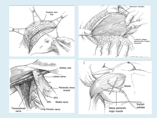 Mastectomy | PPTX | Cancer | Diseases and Conditions