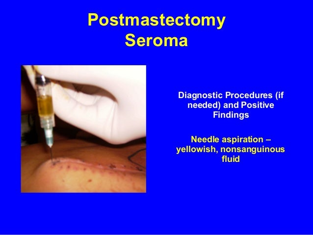 Mastectomy Morbidities: Prevention, Detection, and Treatment (Focus: