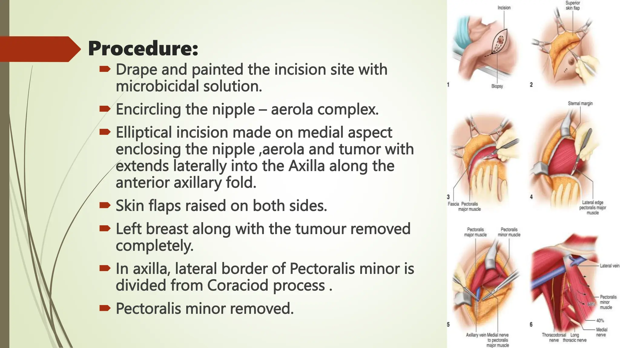 Modified radical mastectomy presentation | PPTX