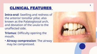 Masticator Space Abscesses of Face .pptx