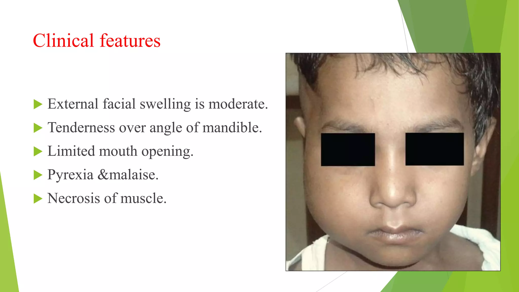 Masticatory space infection | PPTX