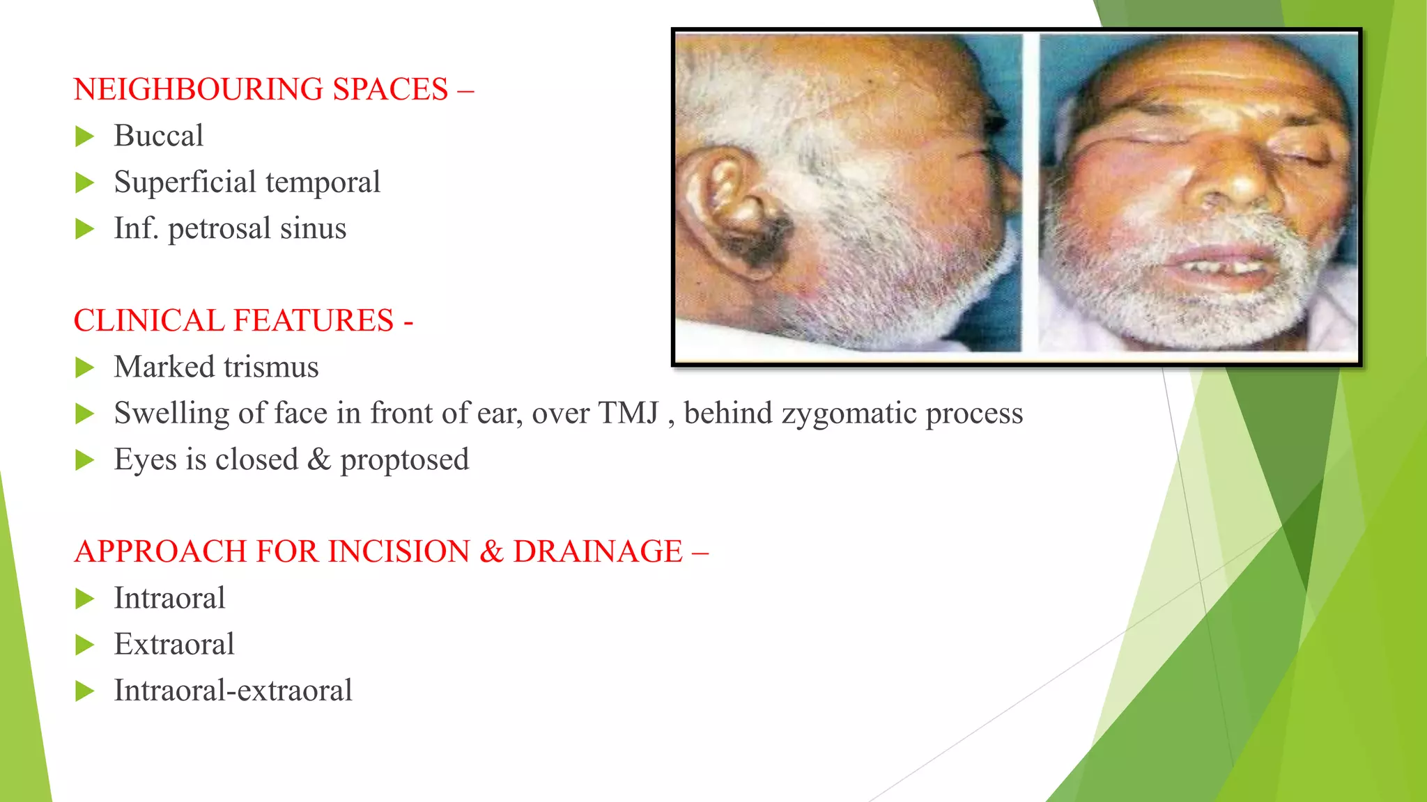 Masticatory space infection | PPTX
