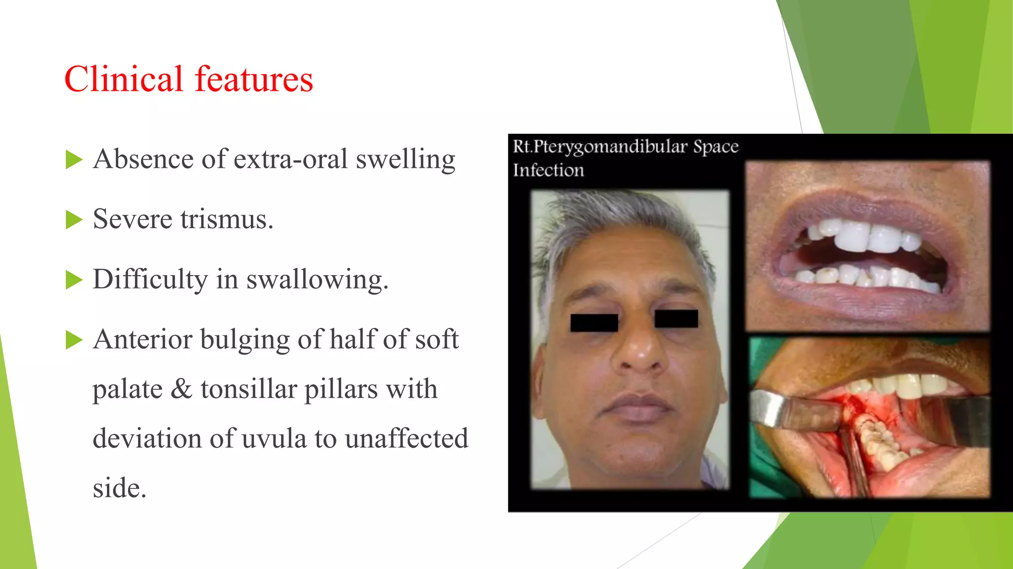 Masticatory space infection