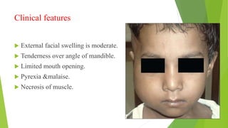 Masticatory space infection | PPTX