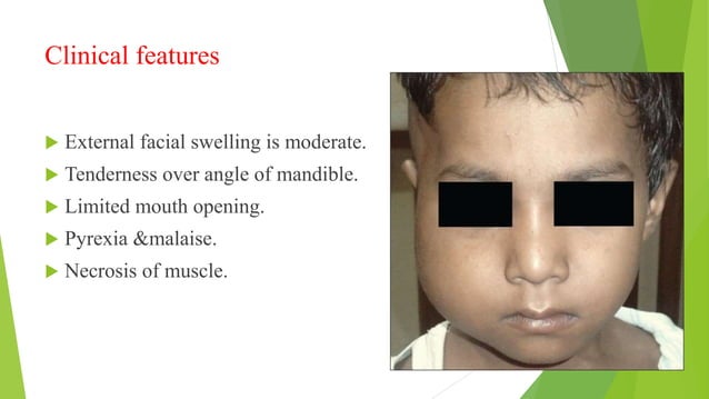Masticatory space infection | PPTX