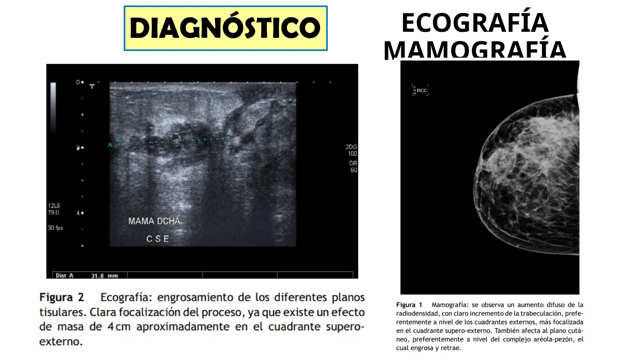 MASTITIS GRANULOMATOSA Diagnóstico ECOGRÁFICO | PPTX