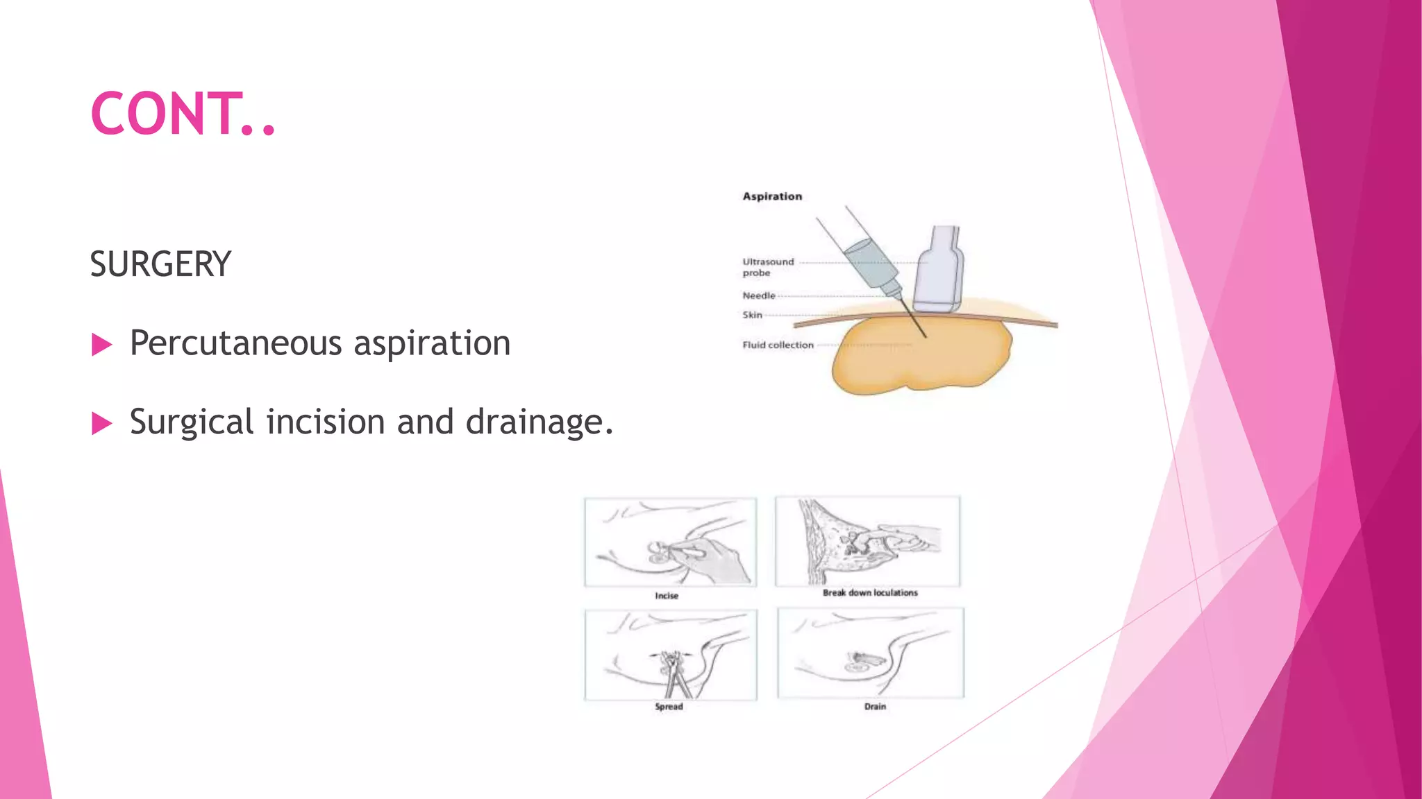 MASTITIS & GYNECOMASTIA_074508.pptx