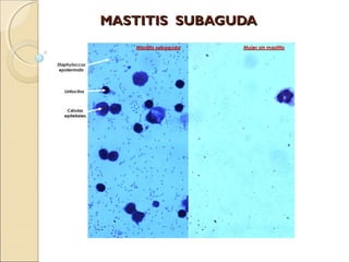 Mastitis y lactancia materna | PPT