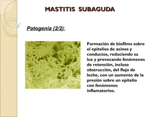 Mastitis y lactancia materna | PPT