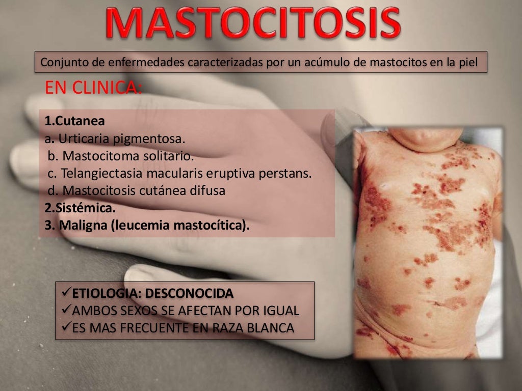 Mastocitosis