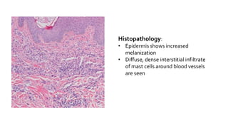 Telangiectasia Macularis Eruptiva Perstans Histology