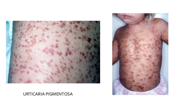 Mastocytosis