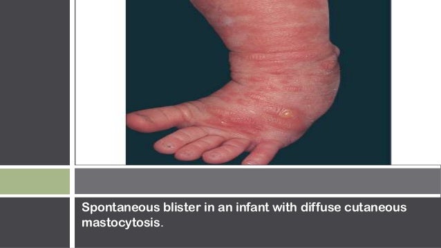 Mastocytosis