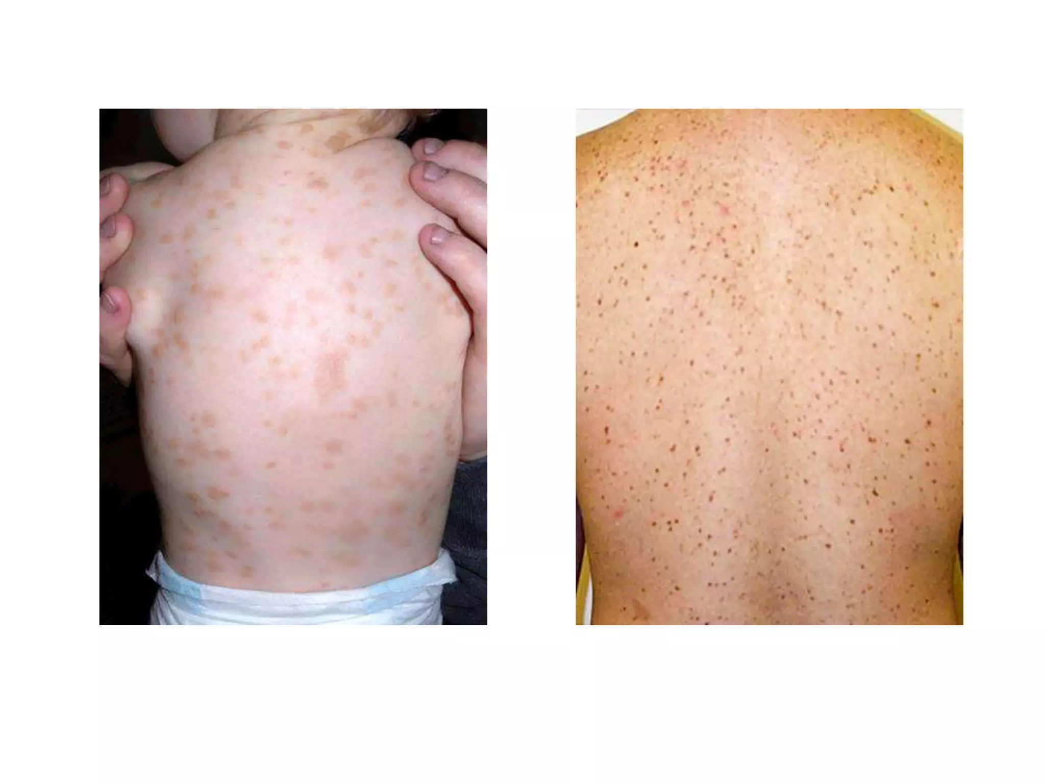 Mastocytosis (Cutaneous and Systemic) | PPTX