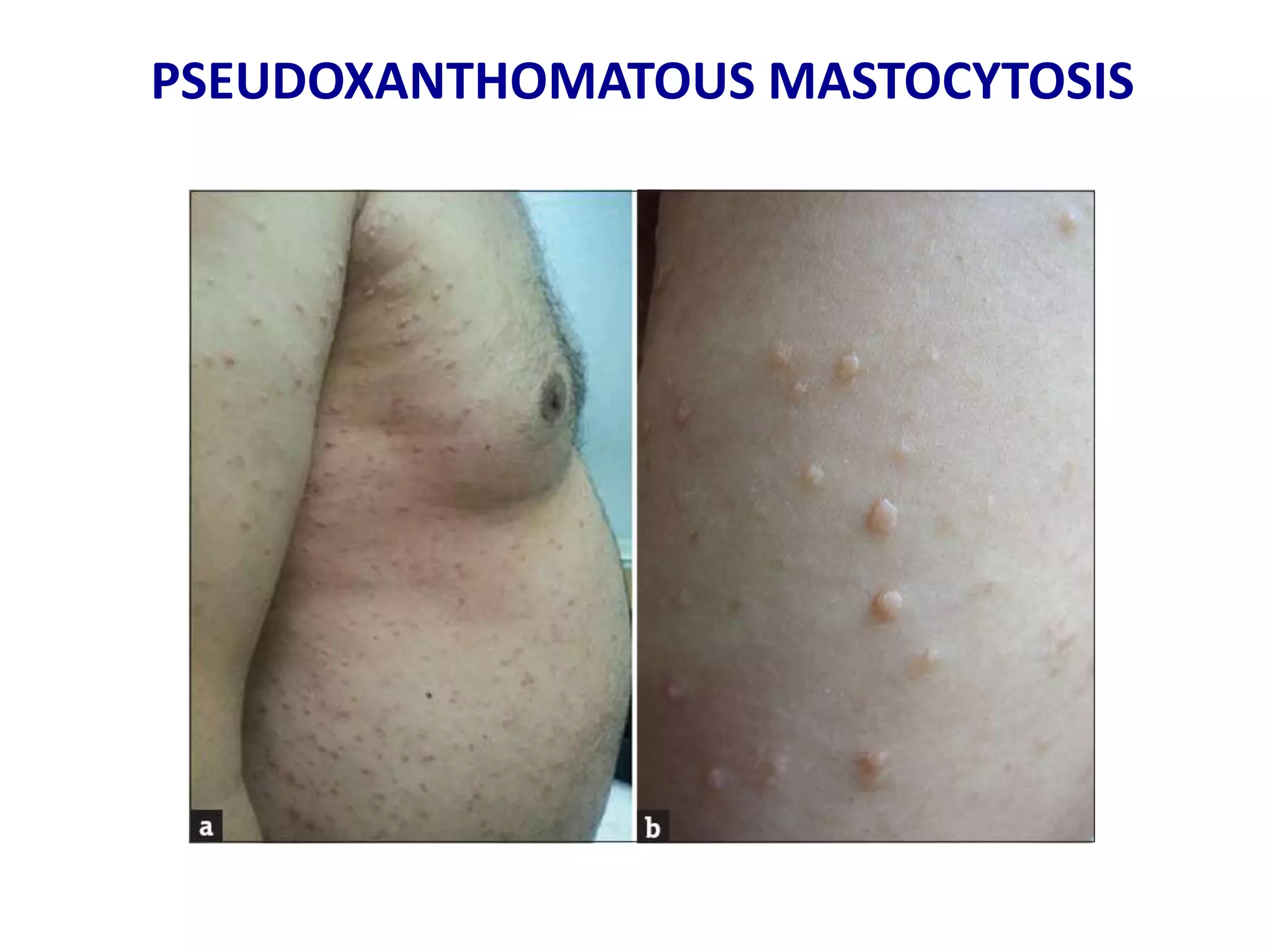 Mastocytosis (Cutaneous and Systemic) | PPTX