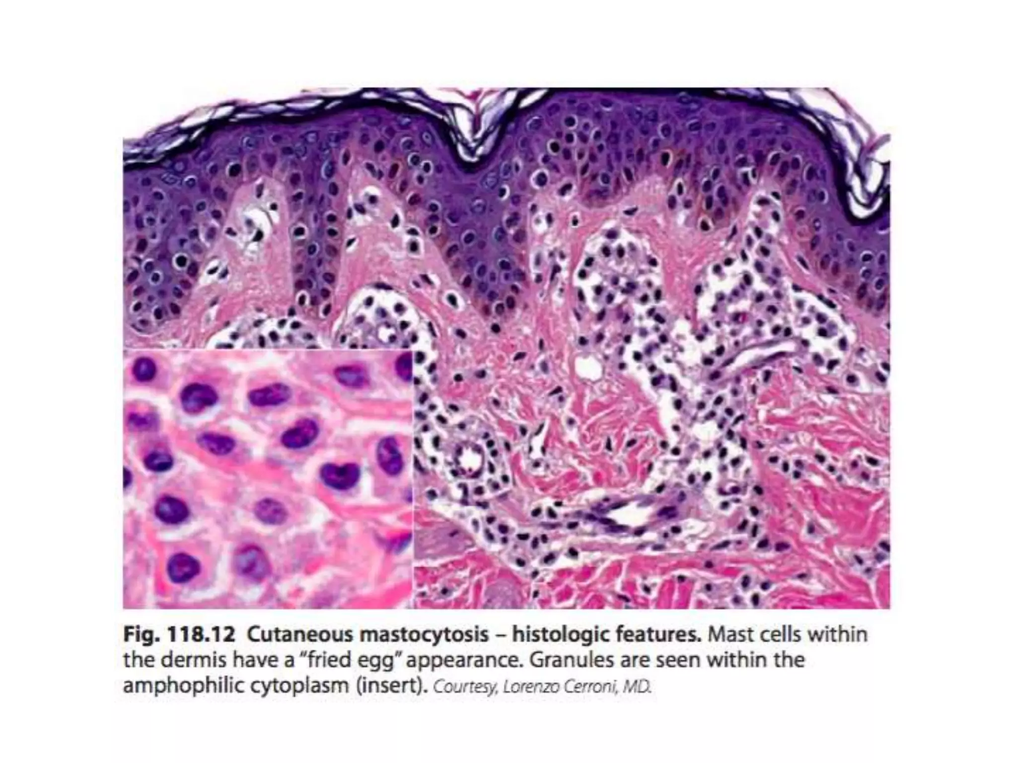 Mastocytosis (Cutaneous and Systemic) | PPTX