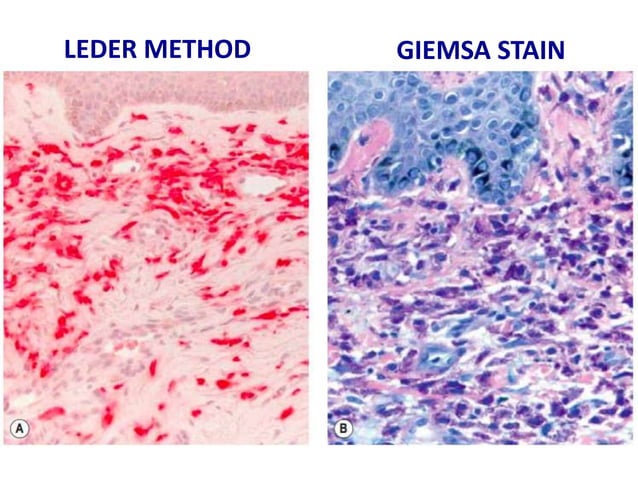 Mastocytosis (Cutaneous and Systemic) | PPTX