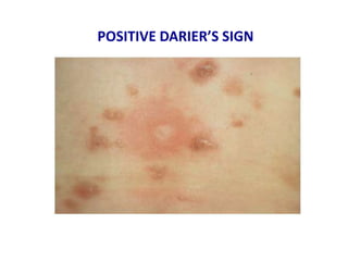 Mastocytosis (Cutaneous and Systemic) | PPT