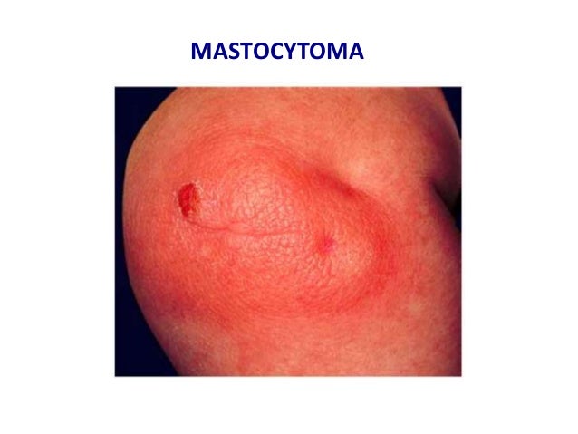 Mastocytosis (Cutaneous and Systemic)