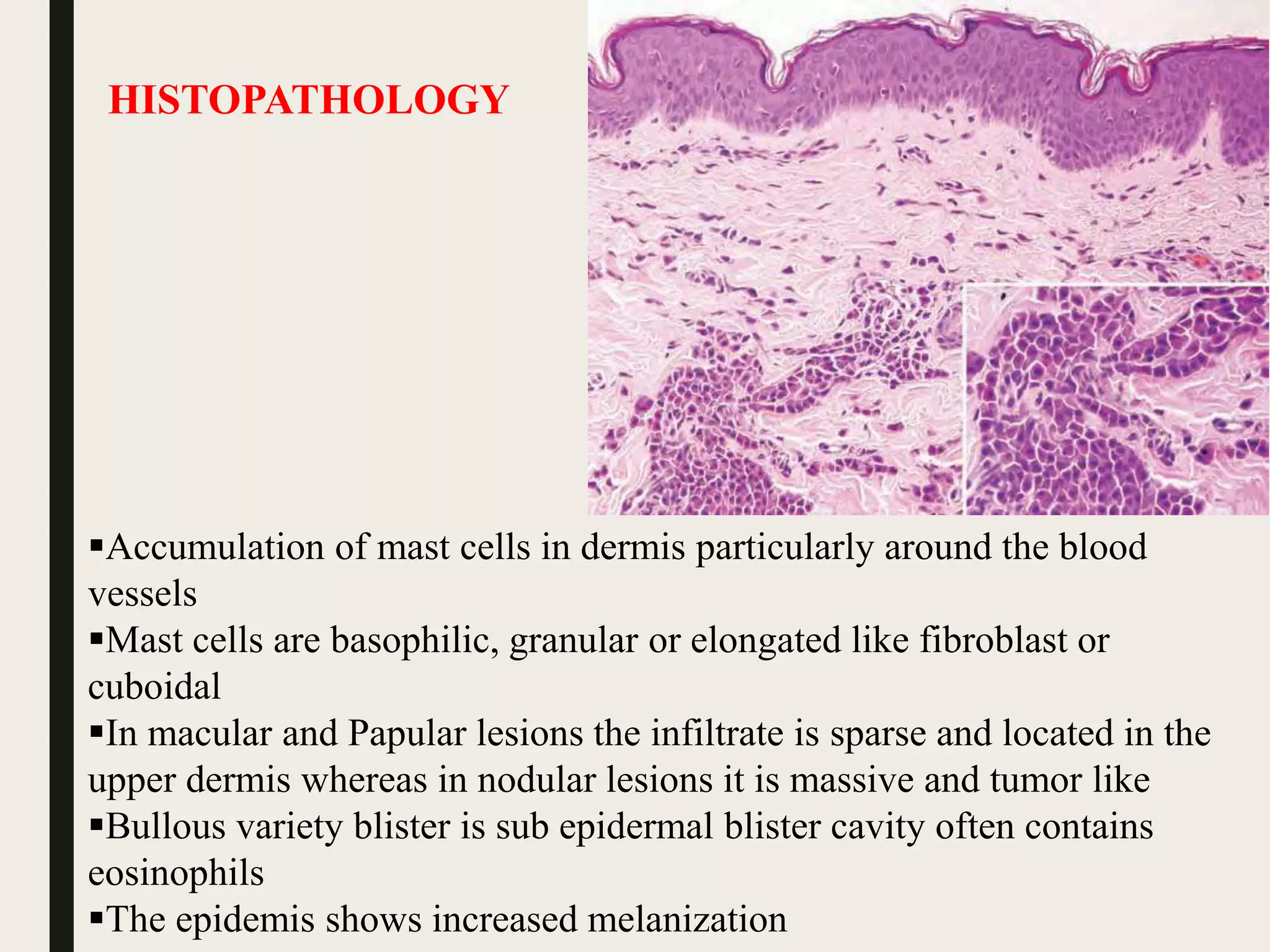 Mastocytosis and autoinflammatory disease presenting in skin | PPTX