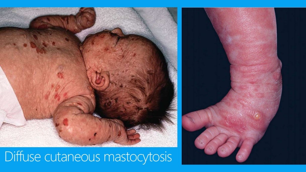 Mastocytosis