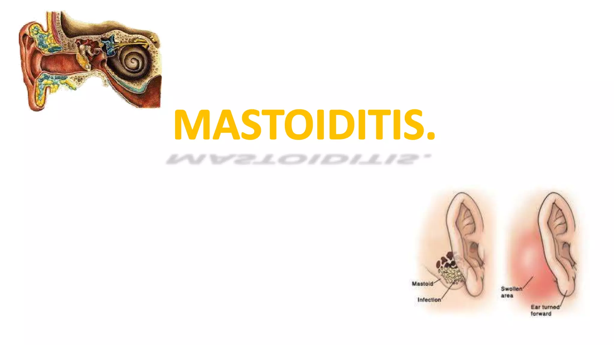 Mastoditis 170811051118 | PPT