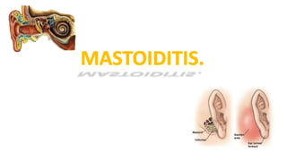 Mastoditis | PPTX