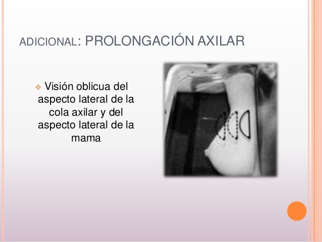 Mastografía