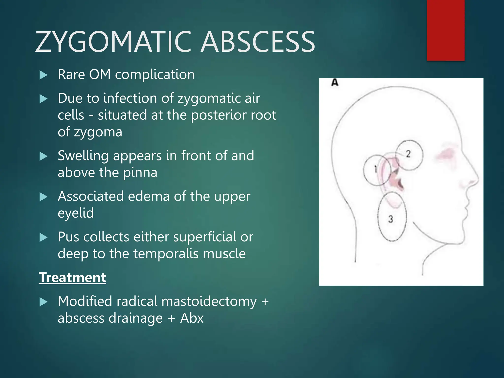 MASTOID ABSCESS, ear nose and throat presentation | PPT